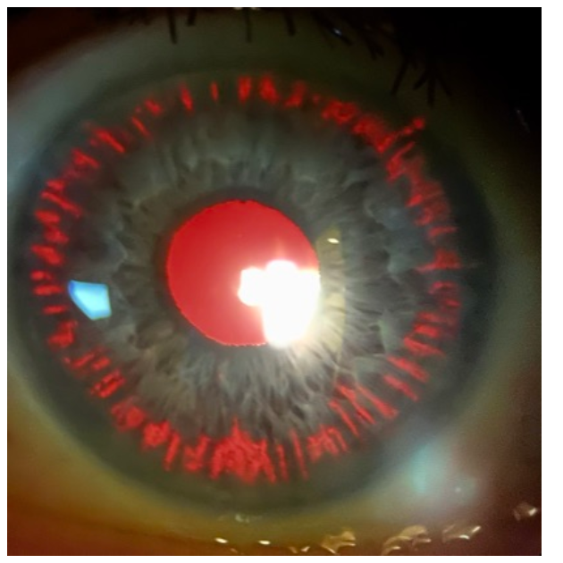 Krukenberg Spindle Pigment Dispersion Syndrome at Lorena Cacho blog