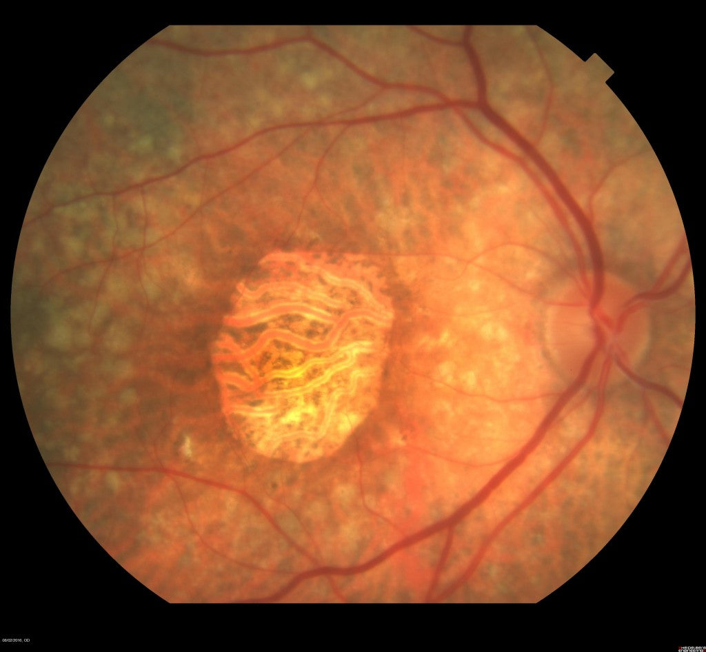 Macular Atrophy Skin
